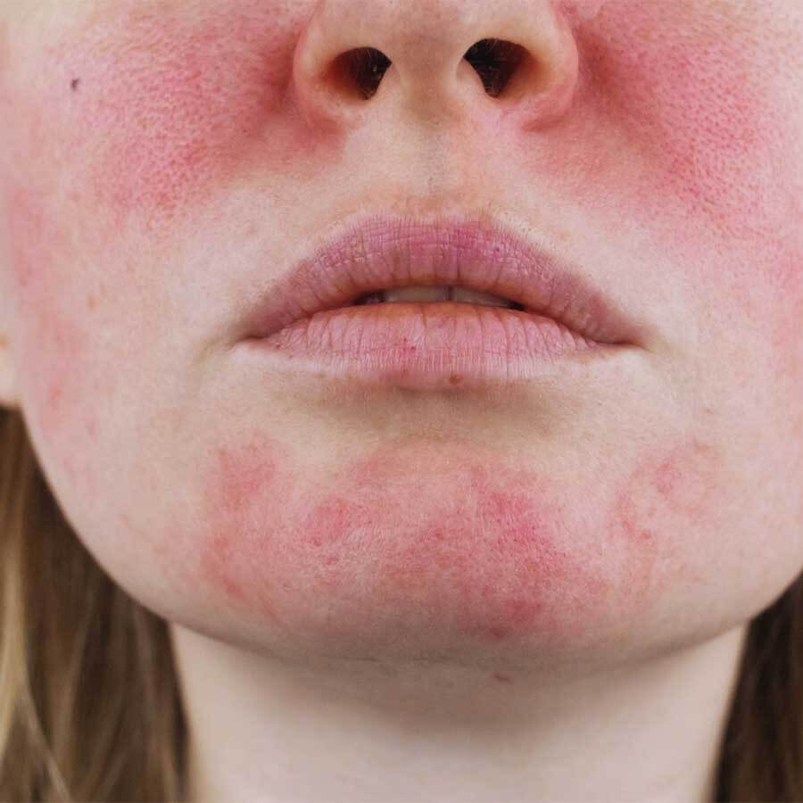 Couperose - proper skin care & tips - Vinoble Cosmetics